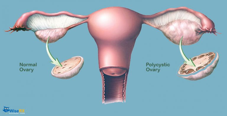 Interesting Facts About PCOS - WiseRxcard