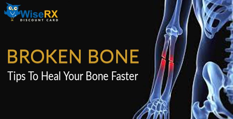 Broken Bone: Tips To Heal Your Bone Faster - WiseRxcard