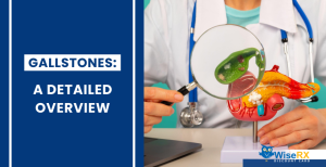 Ultimate Guide to Gallstones